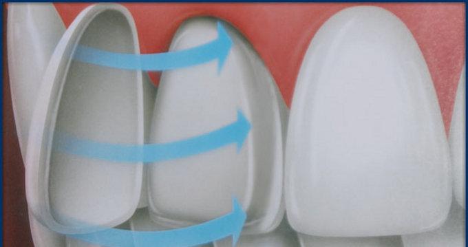 Procelain Veneer - Australian Dental Clinic