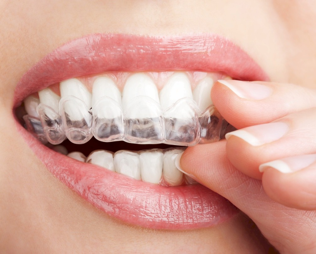 Invisalign - Australian Dental Clinic